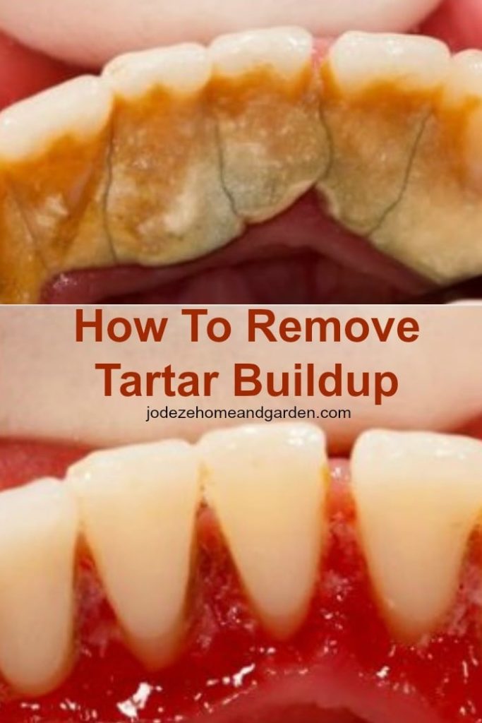 How To Remove Tartar Buildup • NONDON